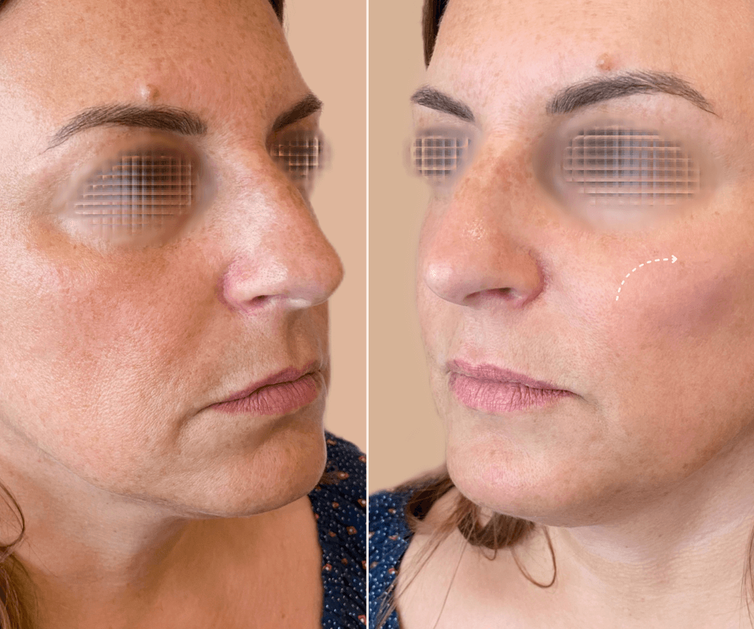 Face Taping Zigomi at Madalyn Hartley blog